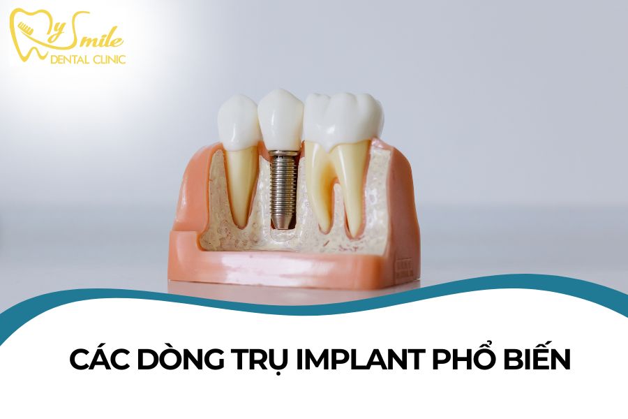 6 loại trụ Implant chính hãng, phổ biến tại Việt Nam - Mysmileclinic