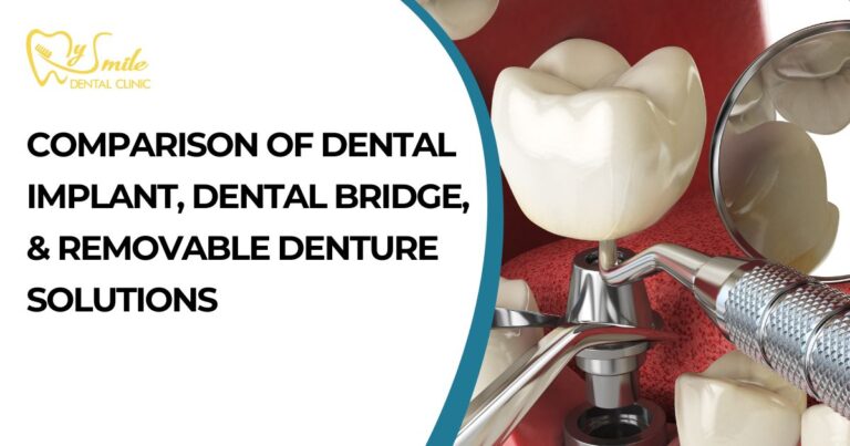 Comparing Dental Implants, Bridges, and Dentures
